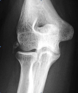 Elbow Pain – Is It Tennis Elbow? | HC Chang Orthopaedic Surgery | Singapore