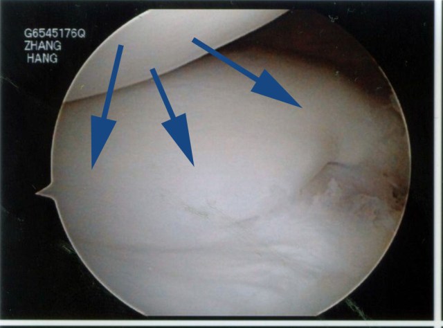 Discoid Meniscus – What To Do If It Is Torn? | HC Chang Orthopaedic ...