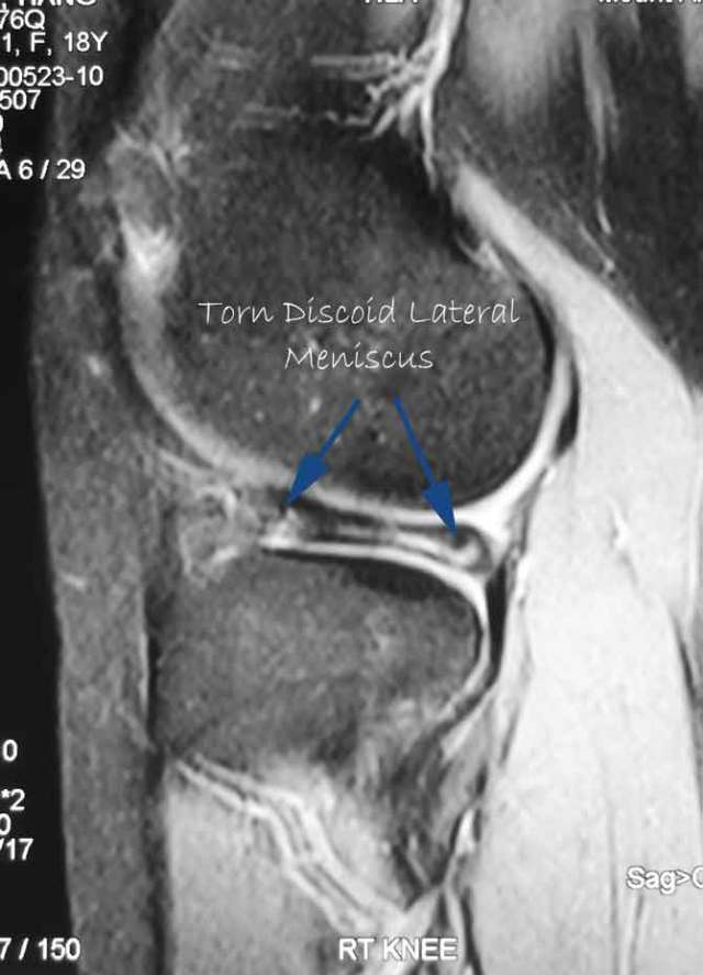 Discoid Meniscus – What To Do If It Is Torn? | HC Chang Orthopaedic ...