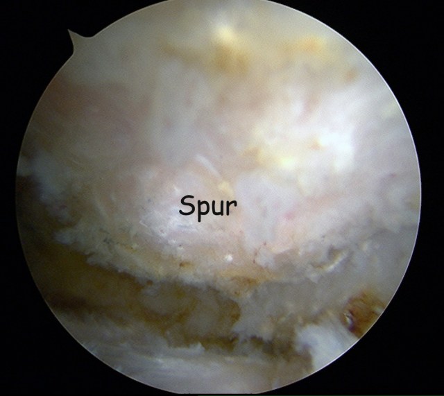 Painful Shoulder – Impingement Syndrome? | HC Chang Orthopaedic Surgery ...