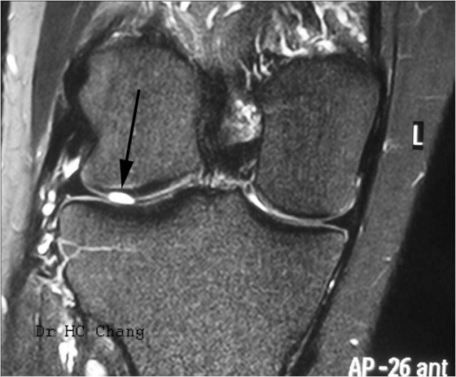 Treatment Options for Cartilage Damage | Cartilage Defects of the Knee ...