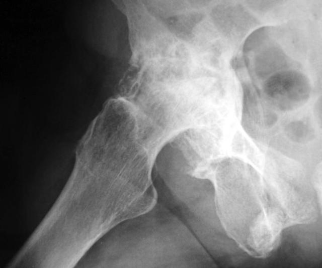 Hip Replacement for Hip Pain from Osteoarthritis | HC Chang Orthopaedic ...