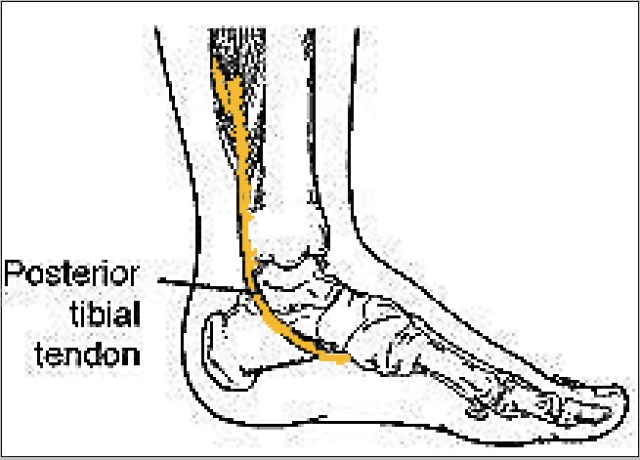 Adult Acquired Painful Flat Foot – Posterior Tibial Tendon Dysfunction ...