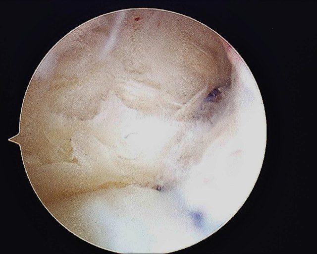 Triangular Fibrocartilage Complex (TFCC) Tear – Treatment by ...