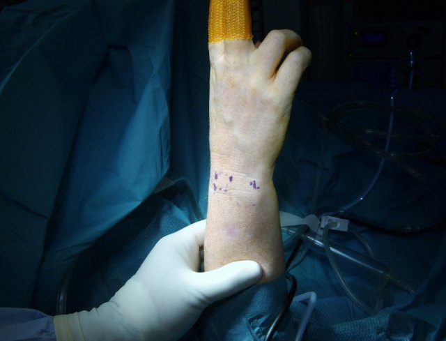 Triangular Fibrocartilage Complex (TFCC) Tear – Treatment by ...