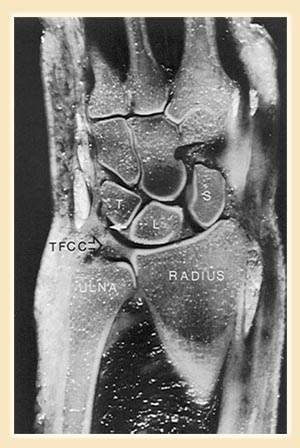 Triangular Fibrocartilage Complex Mri Peripheral Tear Of The