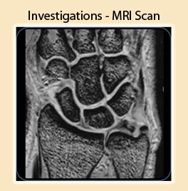Triangular Fibrocartilage Complex (TFCC) Tear – Treatment by ...