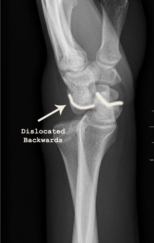 Falling on the Outstretched Hand – A Case of Trans-Scaphoid Perilunate ...