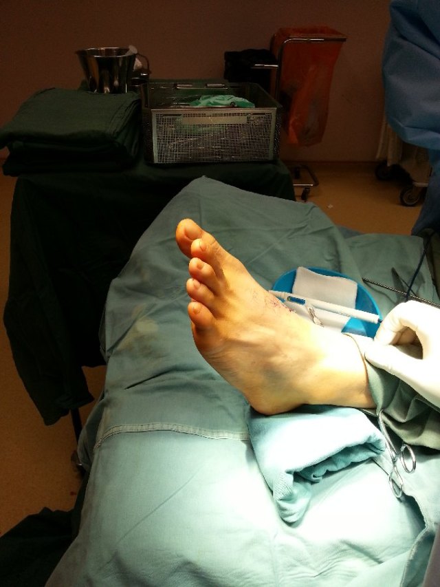 Cut Extensor Tendon to the Big Toe – Surgical Repair | HC Chang ...