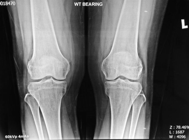 Osteonecrosis Of The Knee Avascular Necrosis (Osteonecrosis) Atlanta,