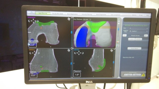 Bicompartmental Knee Makoplasty – Robotic Partial Knee Replacement | HC ...