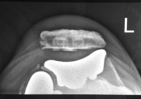 Bicompartmental Knee Makoplasty – Robotic Partial Knee Replacement | HC ...