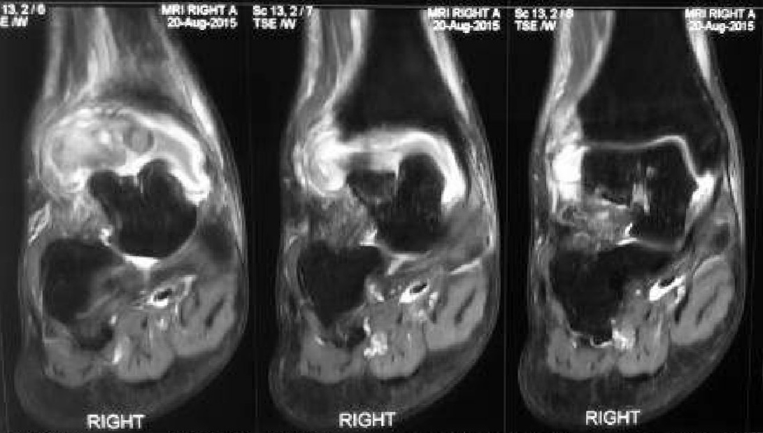 PVNS of the Ankle | Sudden Acute Ankle Pain | HC Chang Orthopaedic ...