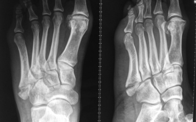 5th Metatarsal Base Displaced Fracture | HC Chang Orthopaedic Surgery ...