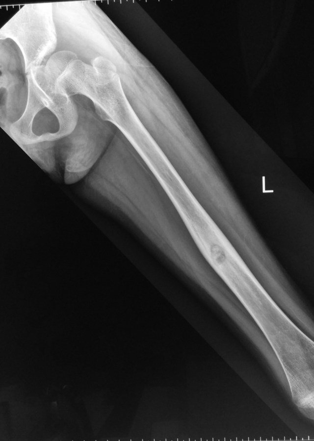 Treatment of Osteoid Osteoma of the Femur | HC Chang Orthopaedic ...