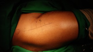 Surgical Treatment of Chronic Proximal Rectus Femoris Rupture | HC ...