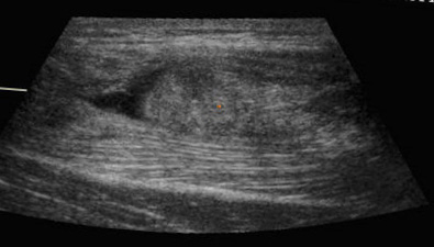 Surgical Treatment of Chronic Proximal Rectus Femoris Rupture | HC ...